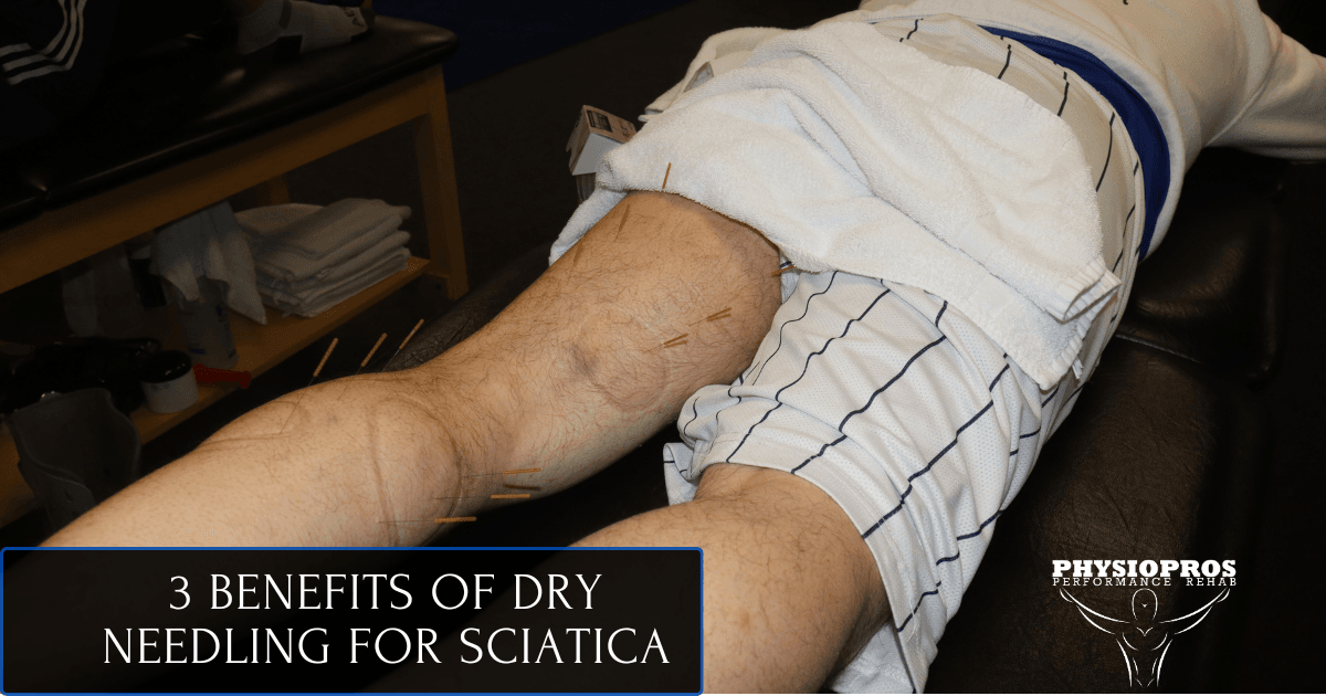 3 Benefits of Dry Needling for Sciatica